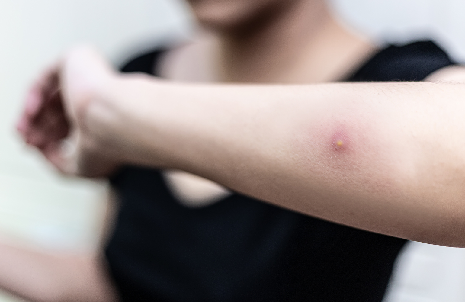 Abszess behandeln: Selbsthilfe oder lieber zum Arzt?