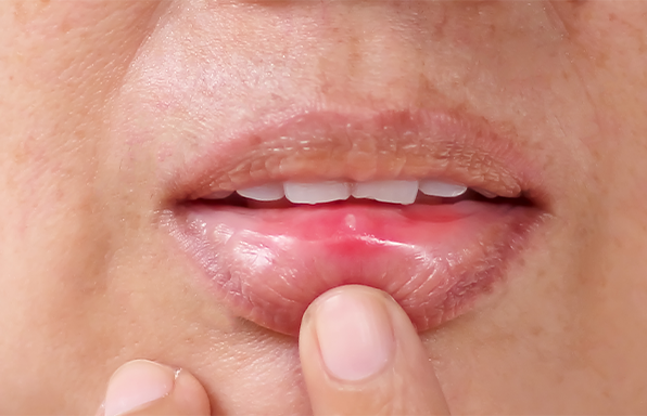 Aphthen im Mund: Ursachen, Behandlung & schnelle Hilfe