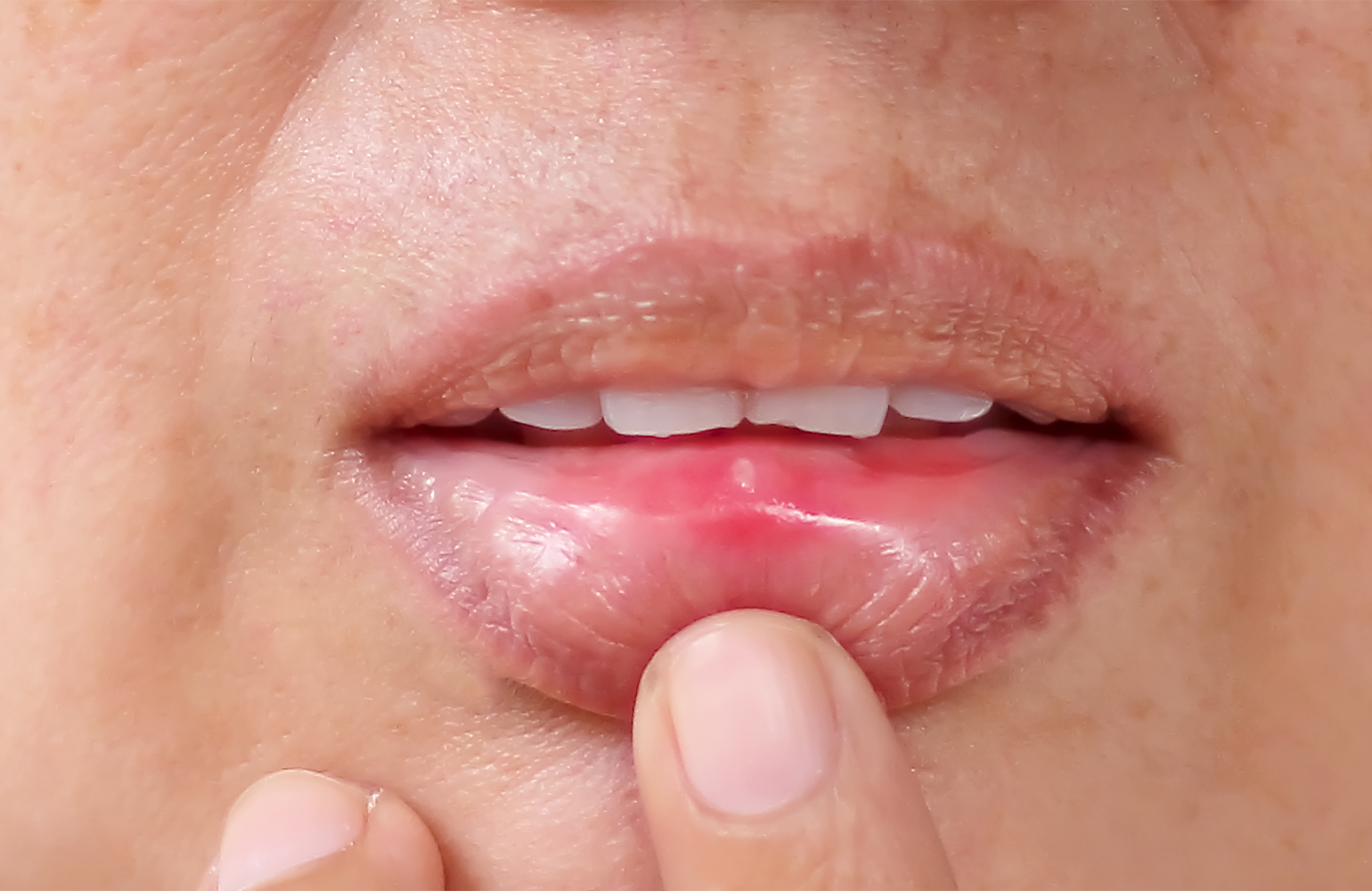 Aphthen im Mund: Ursachen, Behandlung & schnelle Hilfe