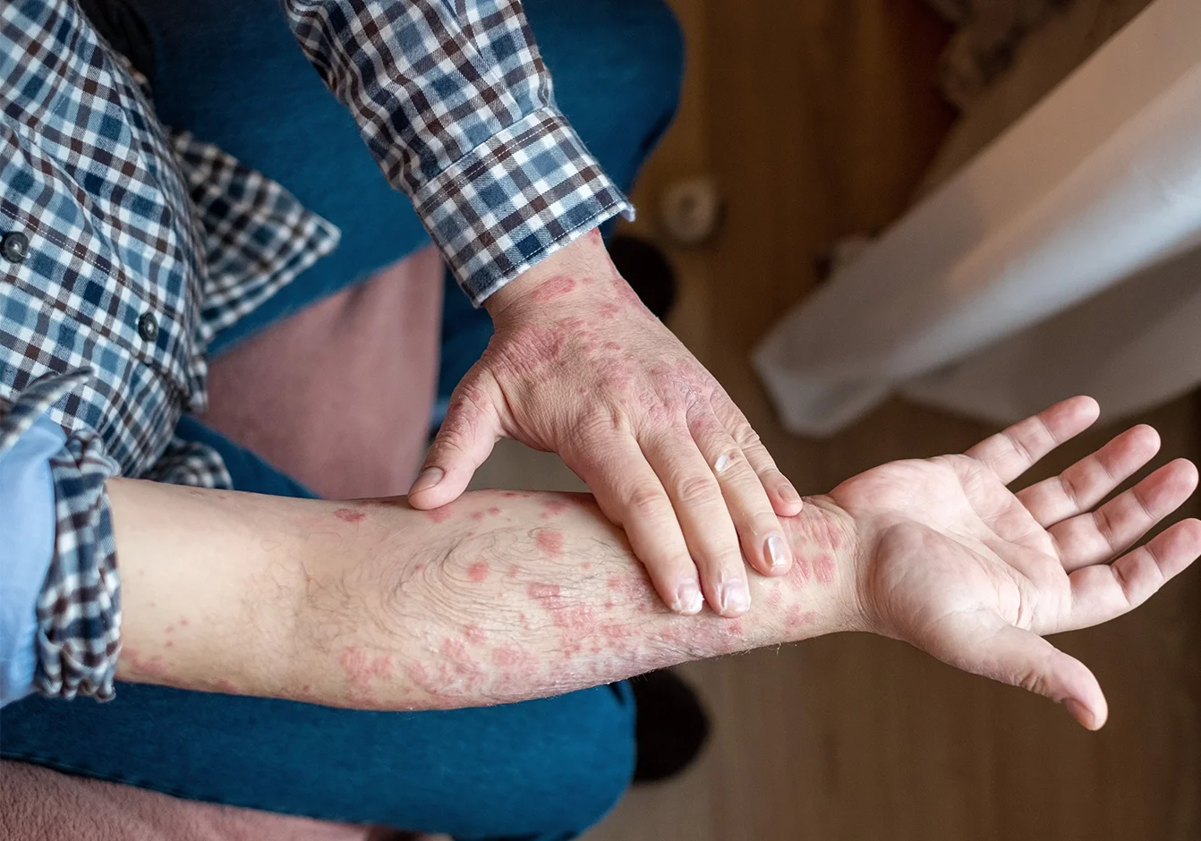 Nesselsucht: Juckender Hautausschlag? Ursachen, Diagnose & Hilfe