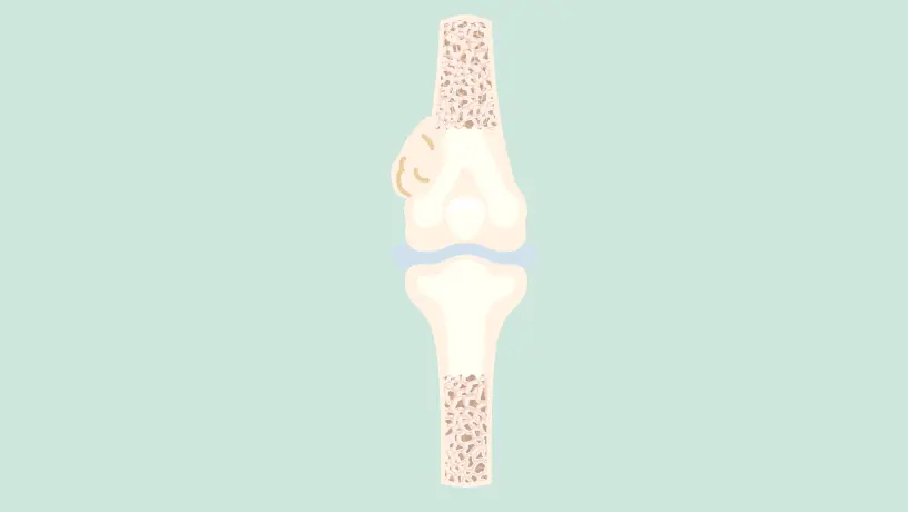 Knochenkrebs erkennen: Symptome, Diagnose, Behandlung | DocMorris