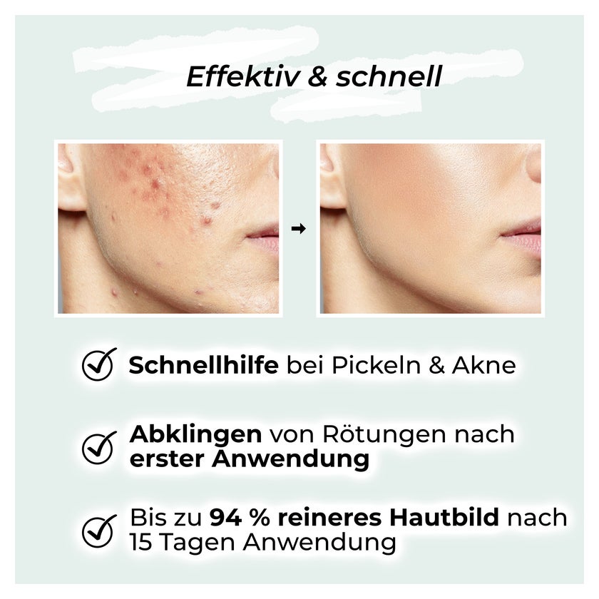 VIGOROUS® Zinksalbe gegen Pickel & Unreinheiten 60 ml online kaufen ...